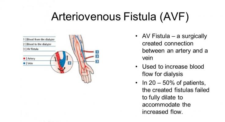 Dialysis Fistula Diagram